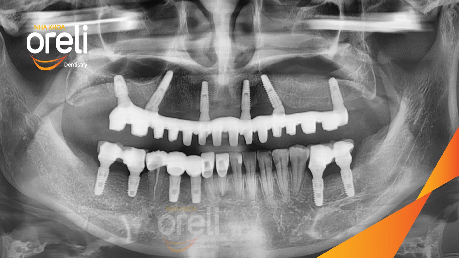 Ca trồng răng Implant toàn hàm trên và 6 răng implant lẻ hàm dưới