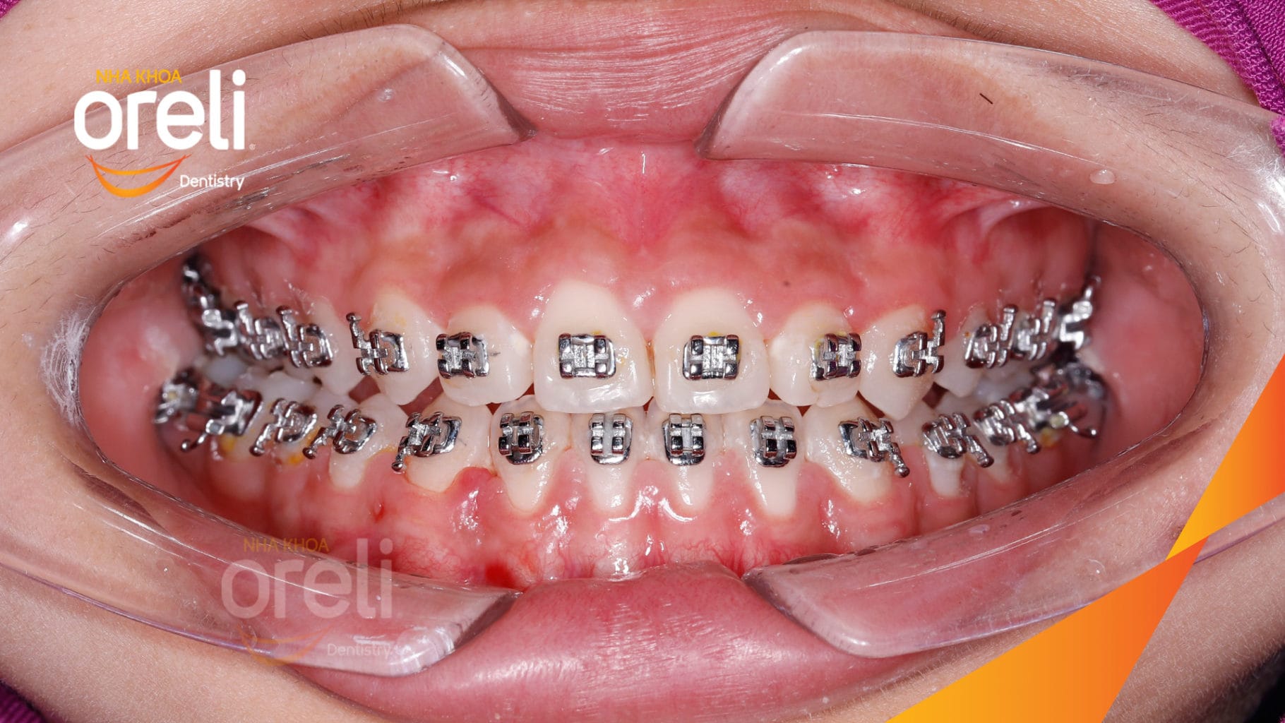 Niềng răng với dây cung đa loop GEAW